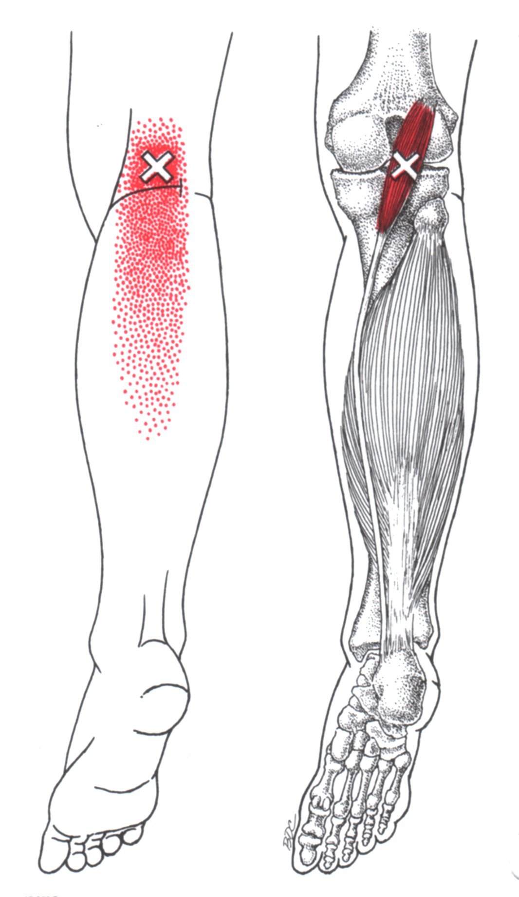 Plantaris The Trigger Point Referred Pain Guide Plantaris The Trigger Point Referred Pain Guide
